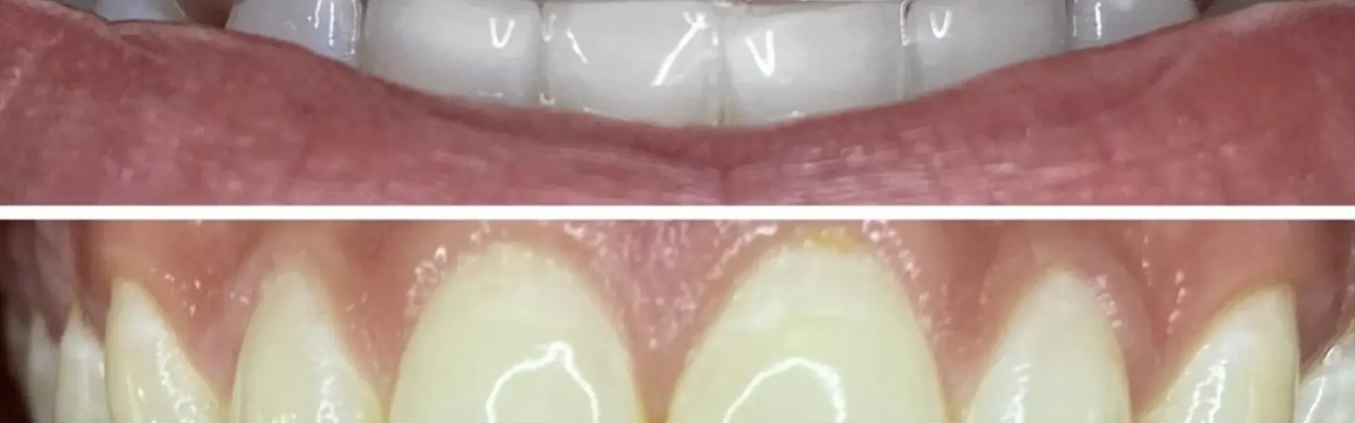 Can a normal dentist do teeth whitening?