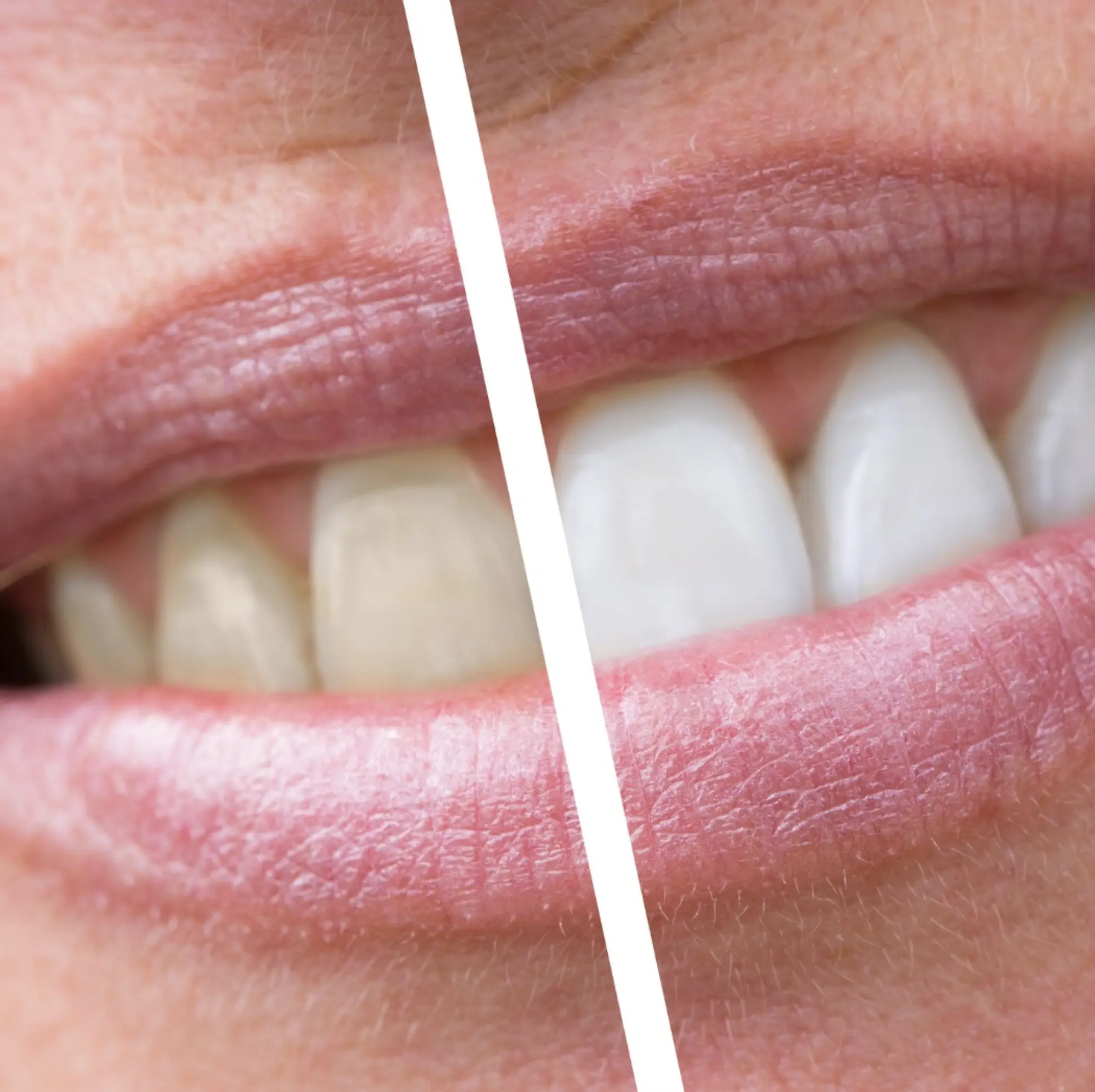 Can a normal dentist do teeth whitening?